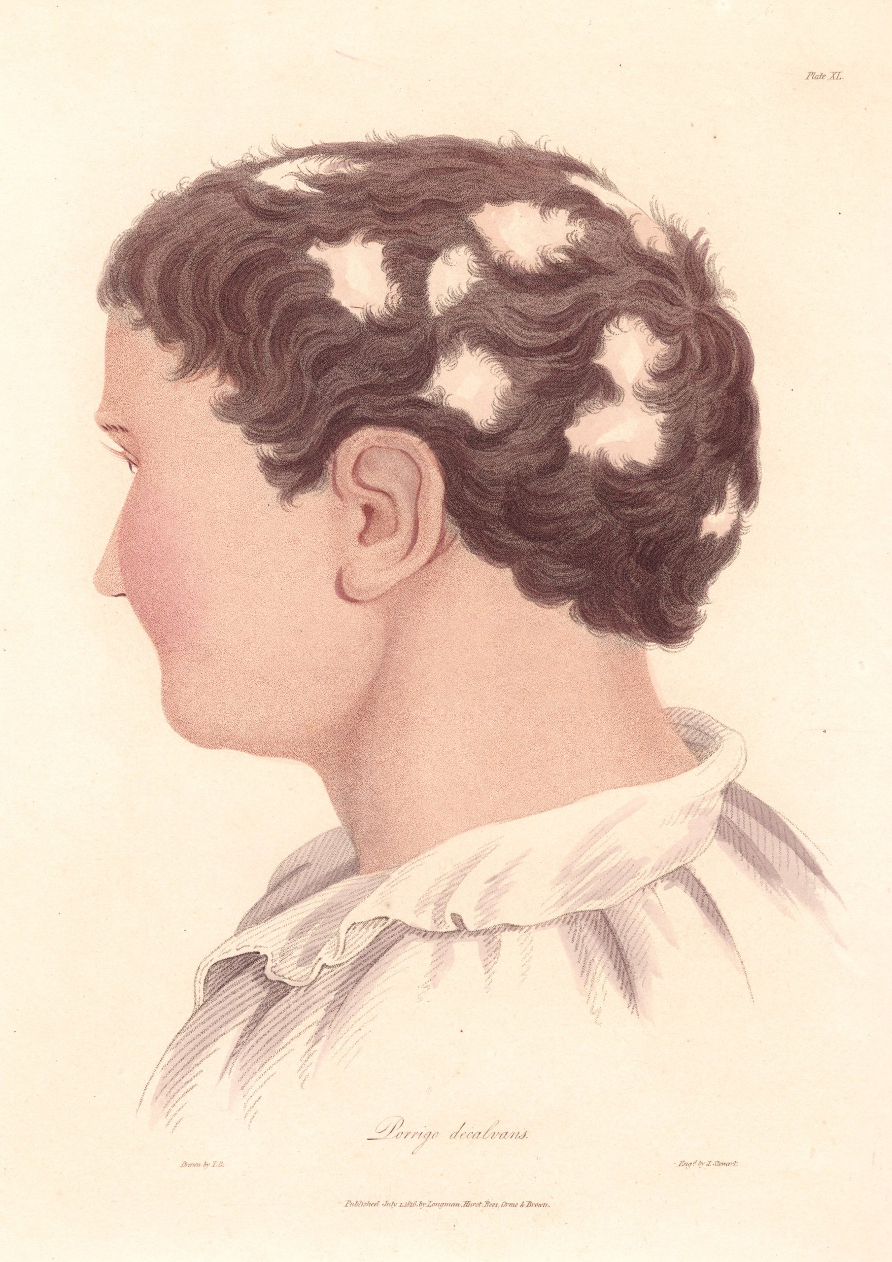 How long has humanity known about alopecia areata? - keratin.com