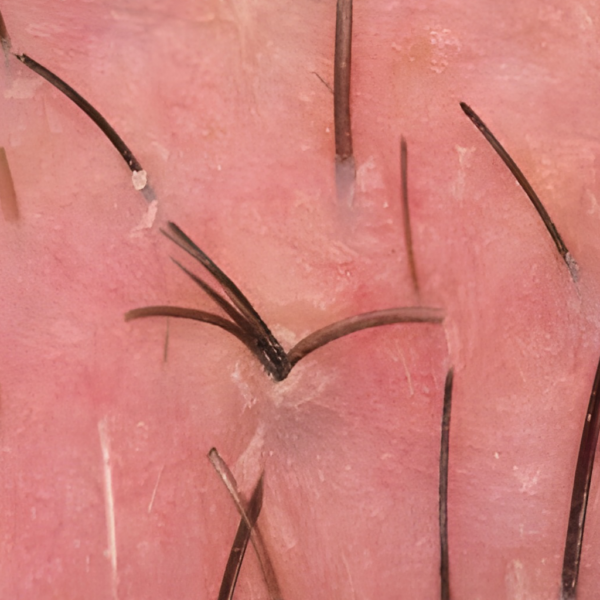 Pili Multigemini: Multiple Hairs Growing from a Single Hair Canal ...