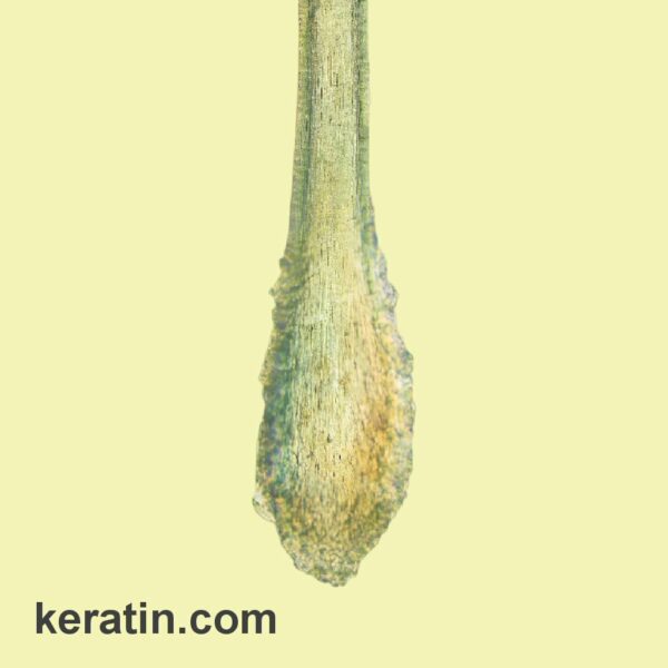 Pili Multigemini: Multiple Hairs Growing from a Single Hair Canal ...